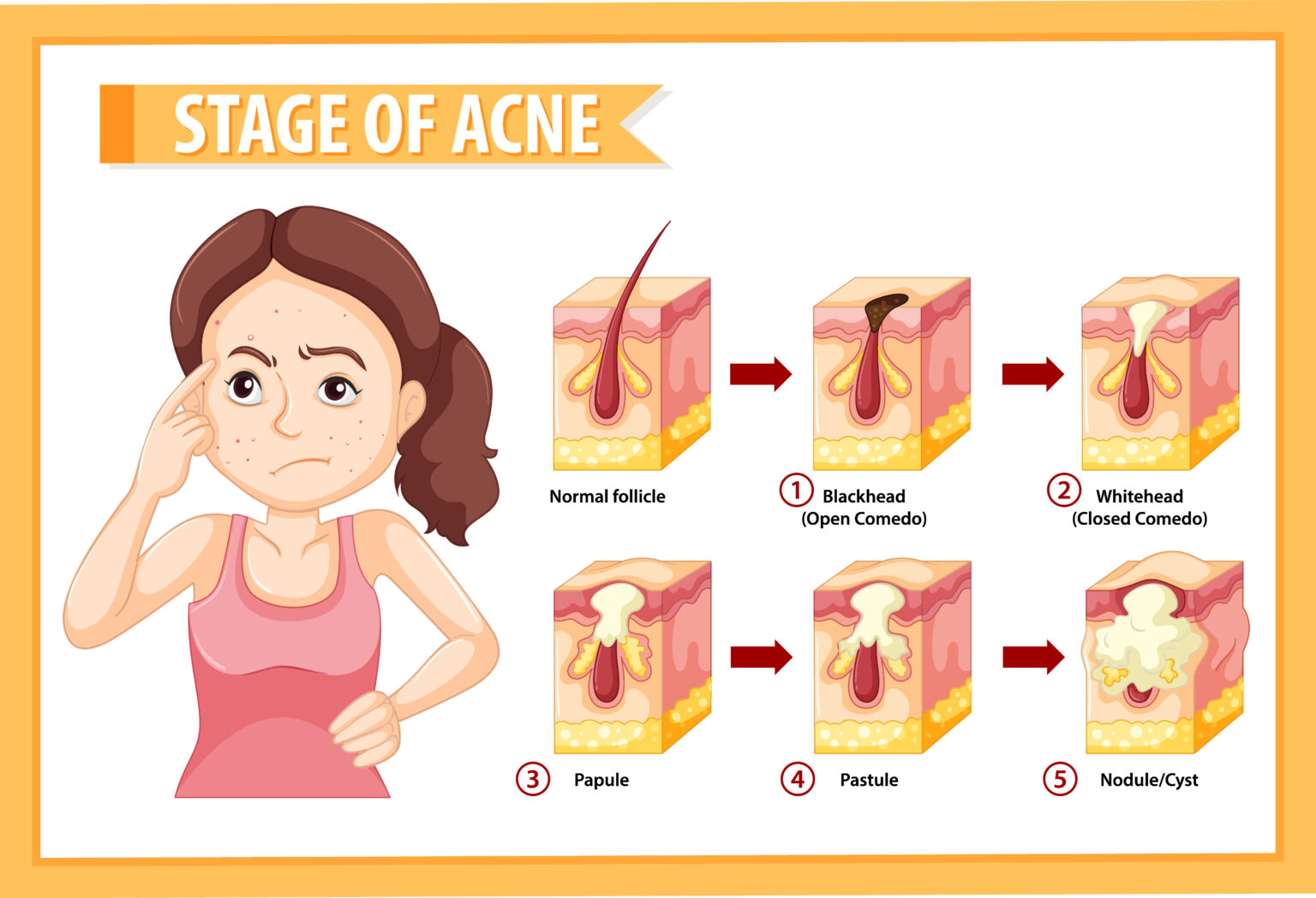 Stages of Acne Progression: From Follicle to Nodule/Cyst.